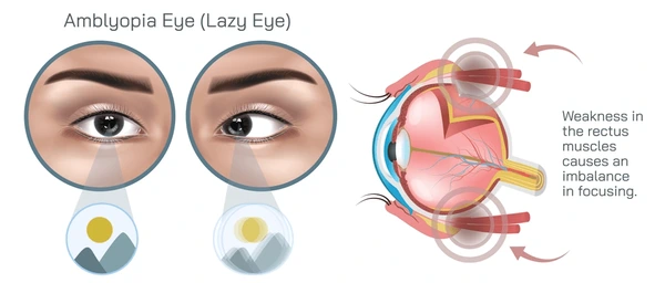 Vision Problems in Children: Early Detection and Intervention | Legazpi ...